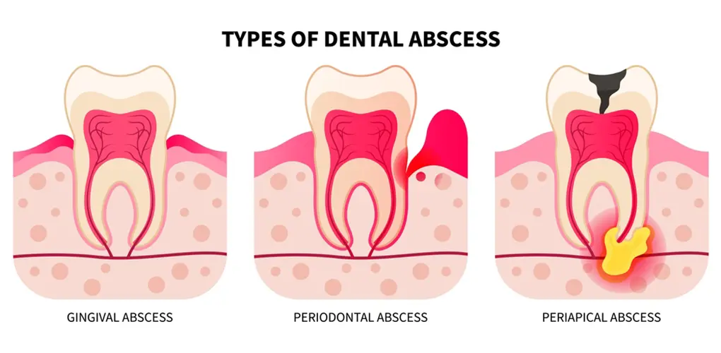 Recognizing and Treating a Dental Abscess: A Comprehensive Guide
