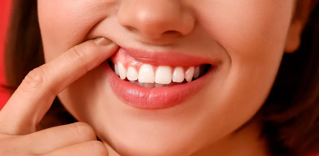 Gum Grafting Techniques, Benefits, and Risks